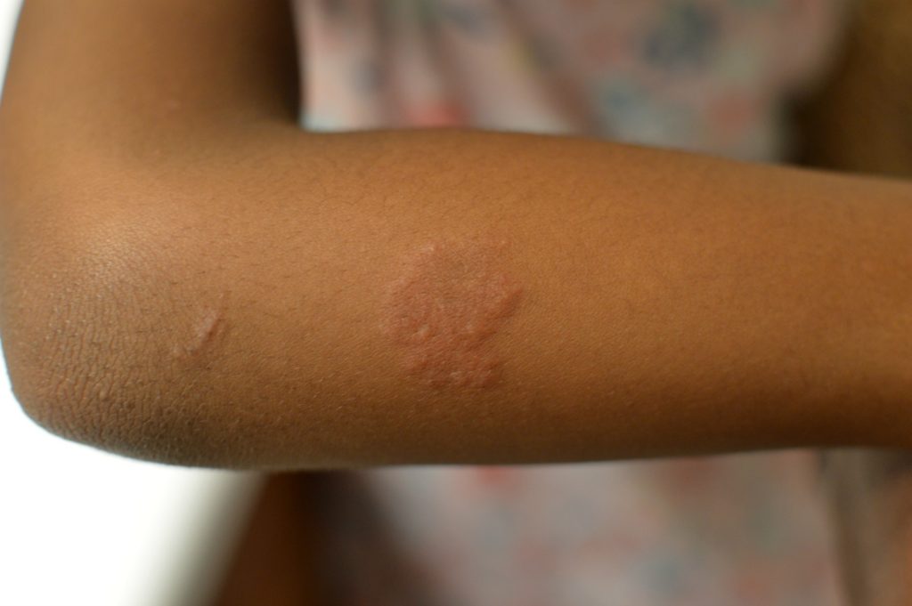 #AskAysa | Get Answers to Your Skin Condition(s) – Pharr Away